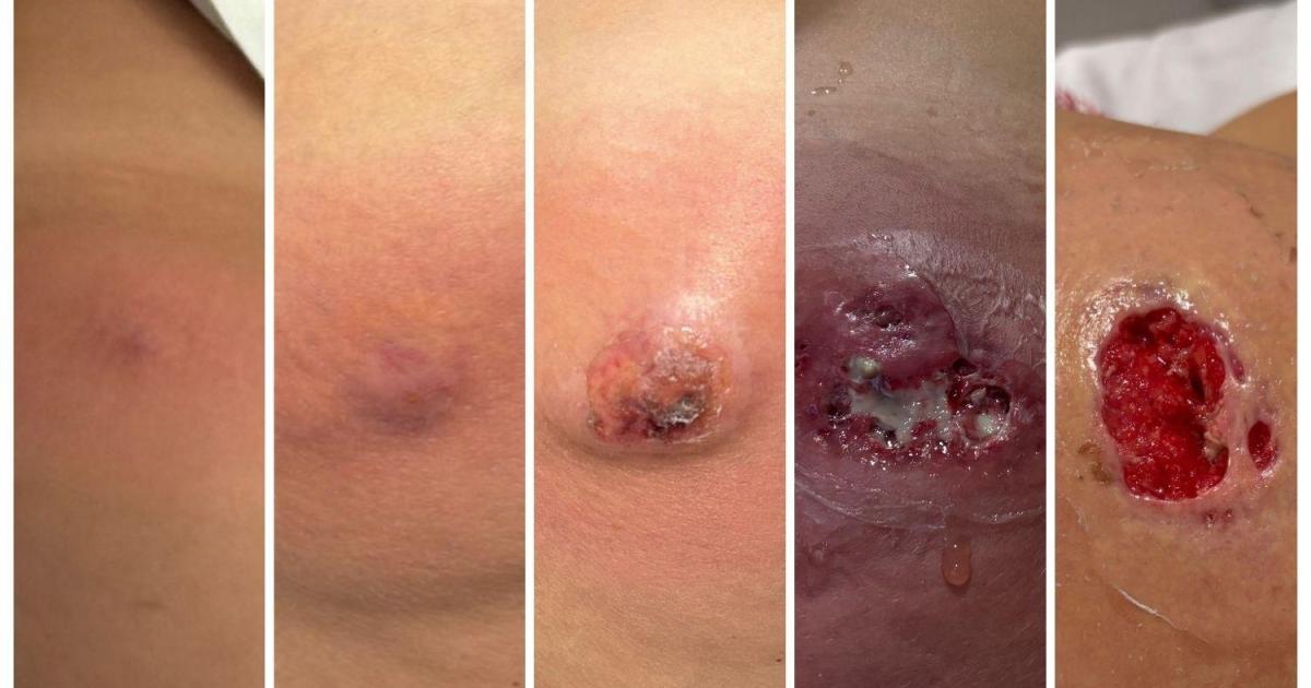 Mediterranean Violin Spider bites on the rise in the Balearics: "The ...